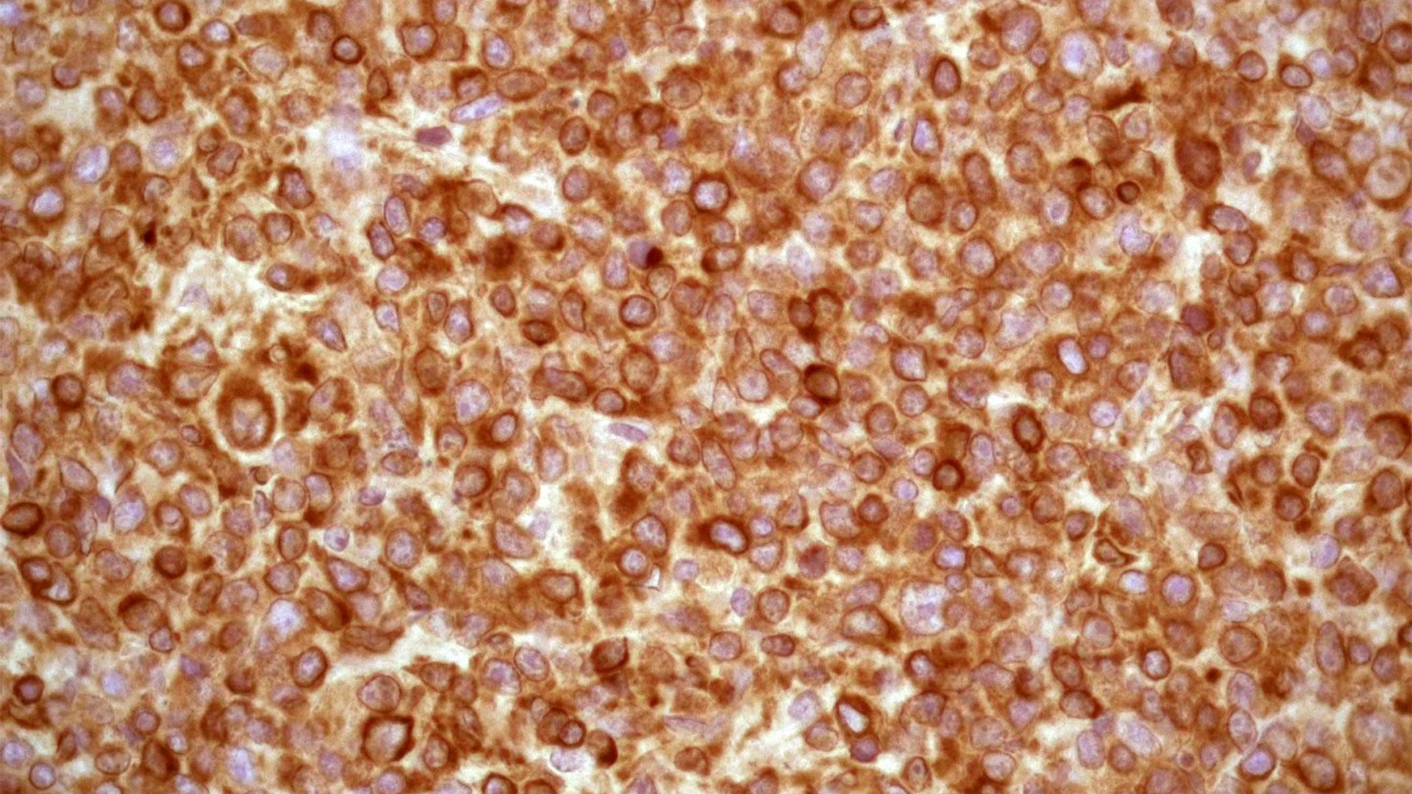A new molecule to inhibit lymphoma growth